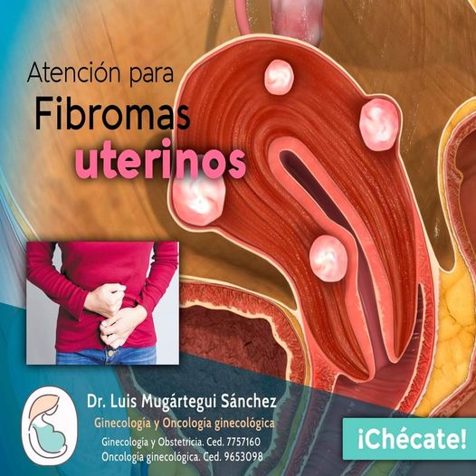SÍNTOMAS DE LOS FIBROMAS UTERINOS
